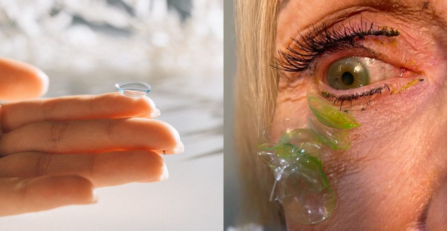 A woman had 23 contact lenses removed from her eye – here’s what ...