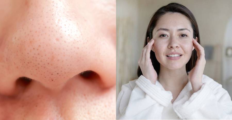 How To Remove Blackheads Without Pain and Scarring