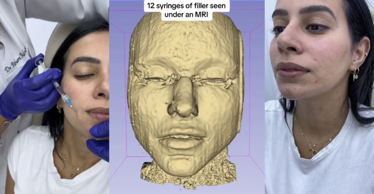 MRI Scan Revealed Expansion of Dermal Fillers!