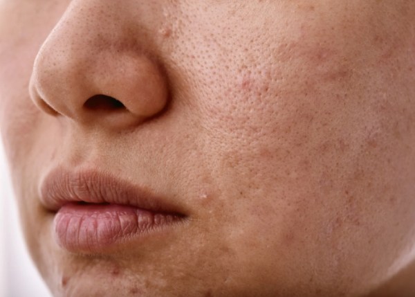 3 PCOS Skin Symptoms That May Surprise You