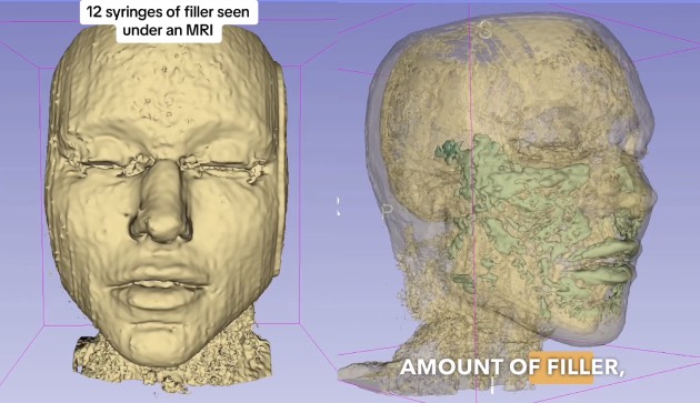 MRI Scan Revealed Expansion of Dermal Fillers!