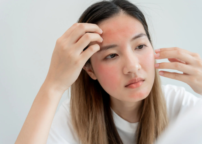 What You Should Know About Heat Rash in Malaysia’s Hot and Humid Weather