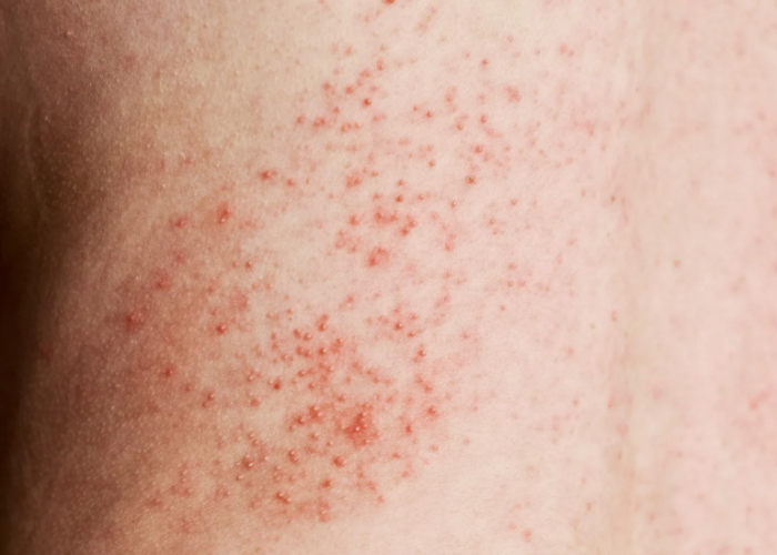 What You Should Know About Heat Rash in Malaysia’s Hot and Humid Weather