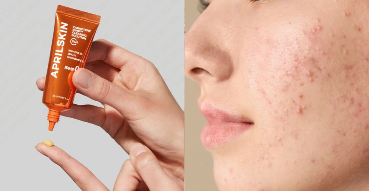 Top 10 Pimple Creams in Malaysia That Actually Work